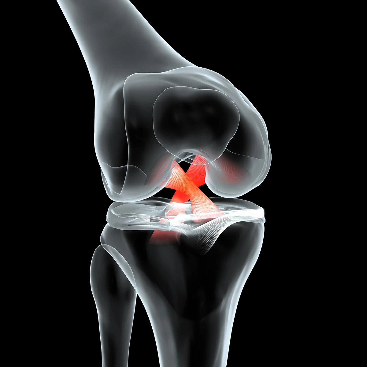 ACL Injury Symptoms And Treatments Dr Paul Miano ACL Injury Symptoms And Treatments Dr Paul Miano